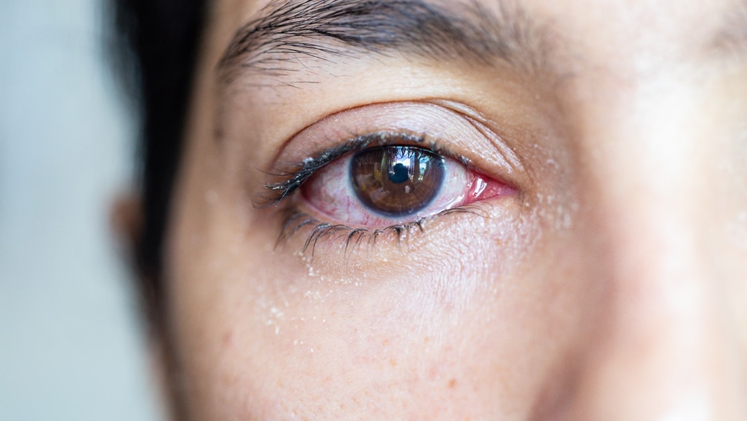 Sunburned Eyes See What It Feels Like Before You Ignore It Sunburned Eyes See What It Feels Like Before You Ignore It